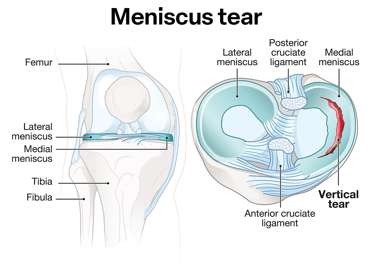 Meniscus Tear Advocate Health Care Meniscus Tear Advocate Health Care